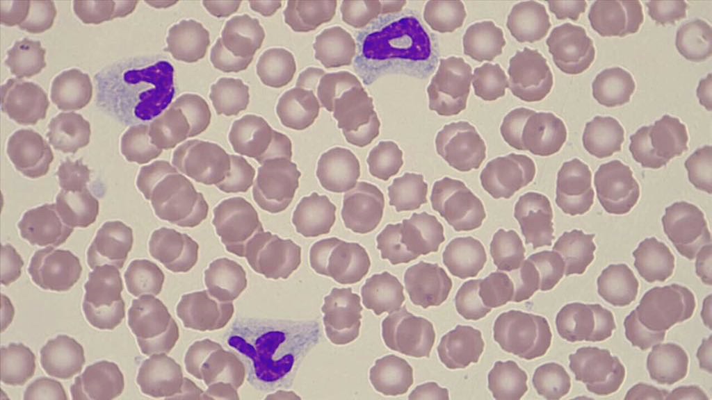 Alterações da morfologia dos Glóbulos Brancos – Atlas de hematologia ...